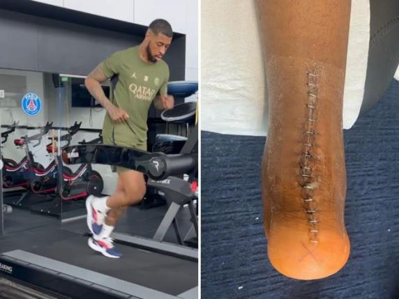 Kimpembe la foto choc dell'infortunio: è fuori da oltre un anno ...