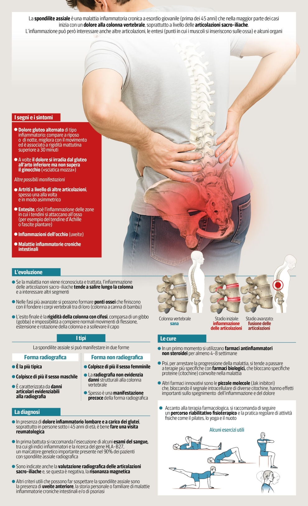 Spondilite assiale (o anchilosante) | Corriere.it