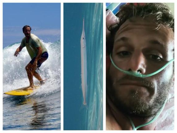 Polmone perforato da un pesce mentre fa surf, Alberto Marcon: «L'aria ...