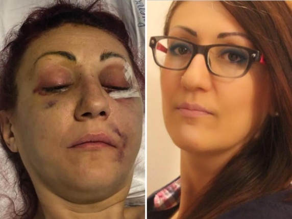 Picchiata dall'ex nel 2022, i medici le hanno ricostruito il volto ...