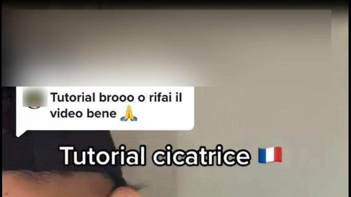 Cicatrice Francese Su Tiktok Ragazzini A Scuola Con Lividi Sul Viso