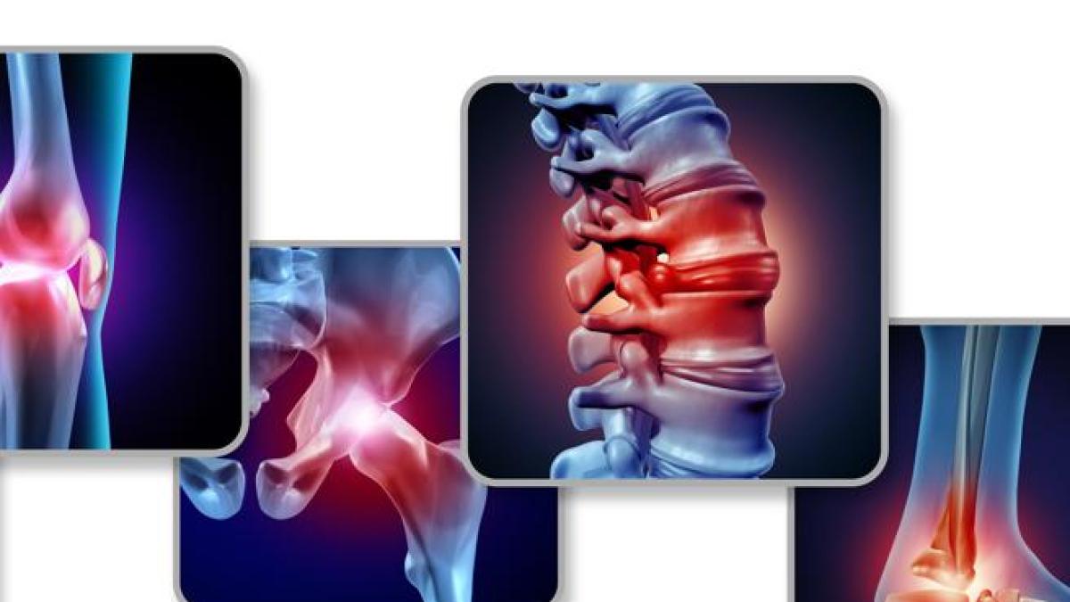 L’artrosi, i pazienti multimorbidi e la lezione di Piero Angela: perché ...