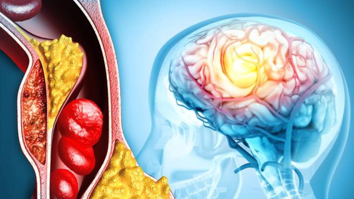 Dall’ictus (ischemico) al colpo apoplettico: i possibili danni, quando ...